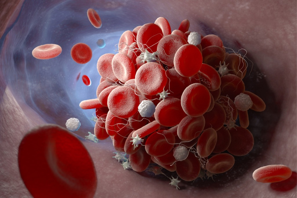 WHAT YOU SHOULD KNOW ABOUT DISSEMINATED INTRAVASCULAR COAGULATION WHAT YOU SHOULD KNOW ABOUT DISSEMINATED INTRAVASCULAR COAGULATION