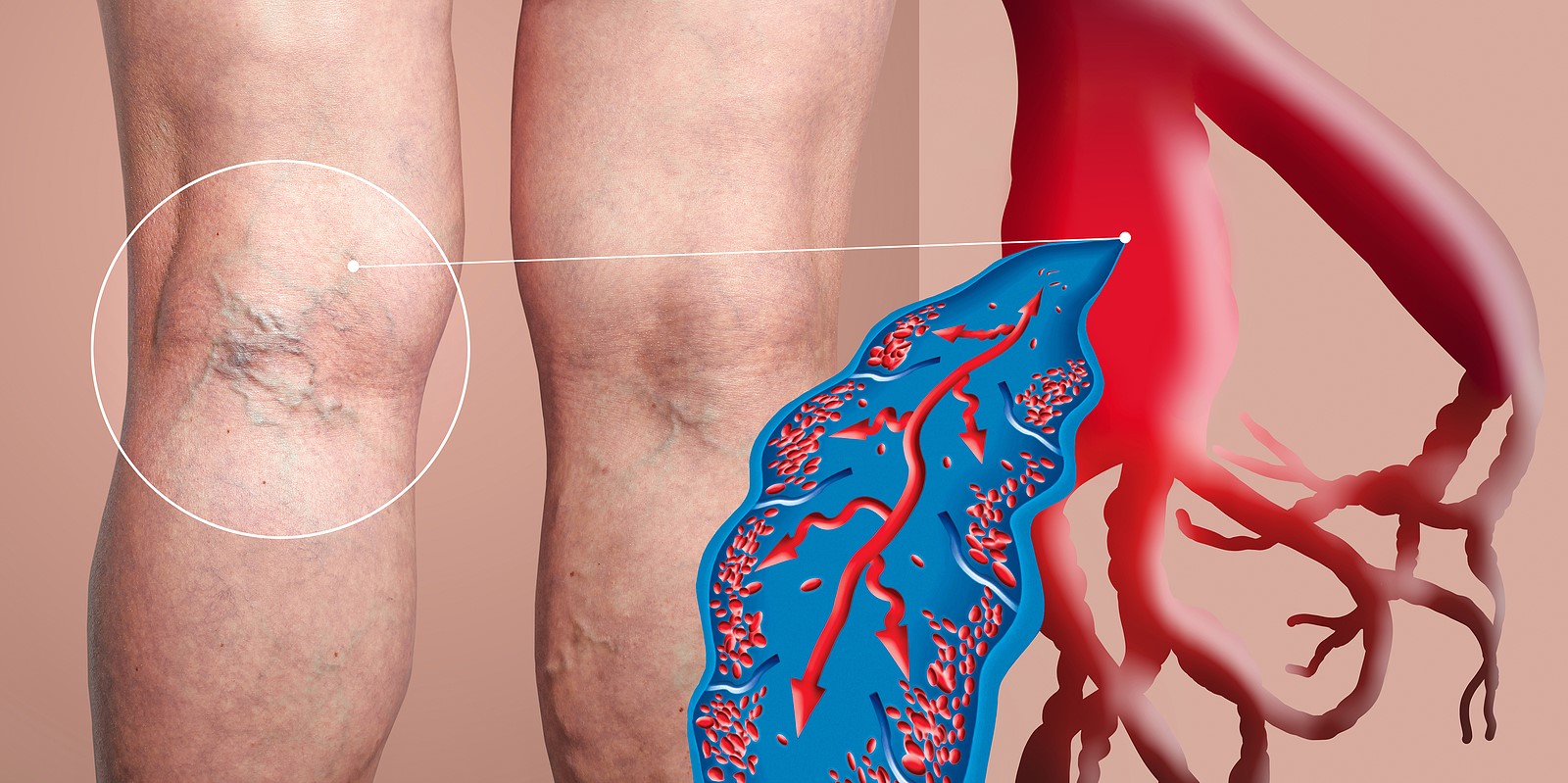 PERONEAL VEIN PHLEBITIS AND THROMBOPHLEBITIS: UNDERSTANDING CAUSES ...